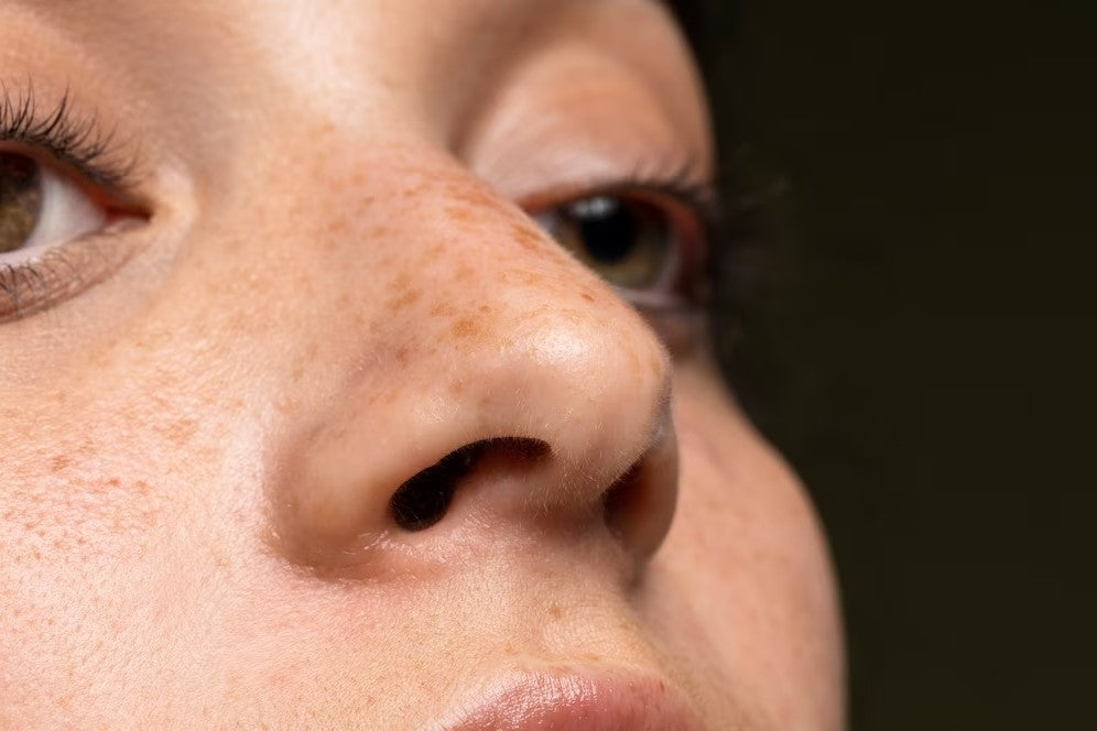 THE MELANIN CANVAS: NAVIGATING HYPERPIGMENTATION IN INDIAN SKIN ...